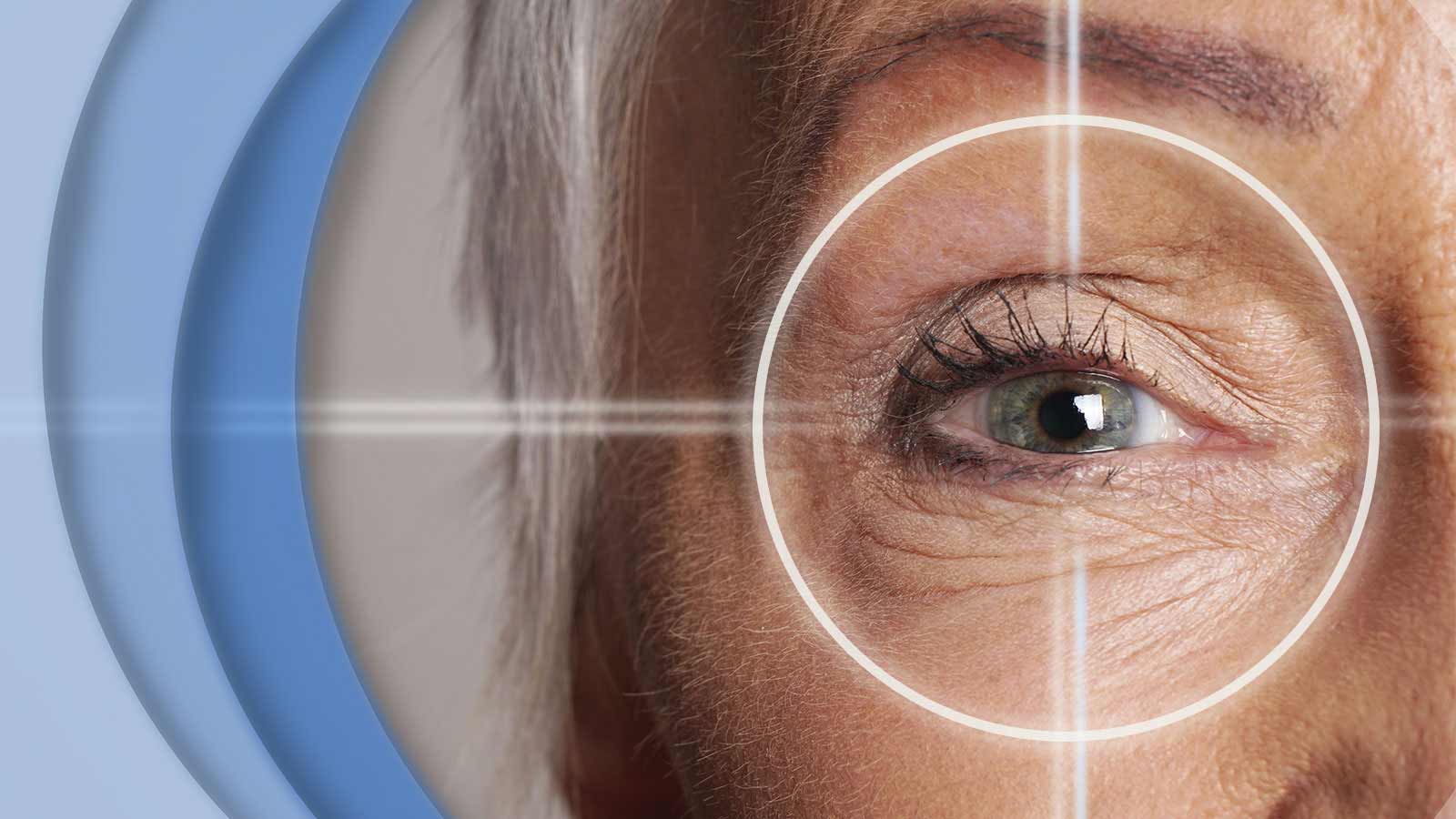 Intervento di cataratta - Vista Vision Group